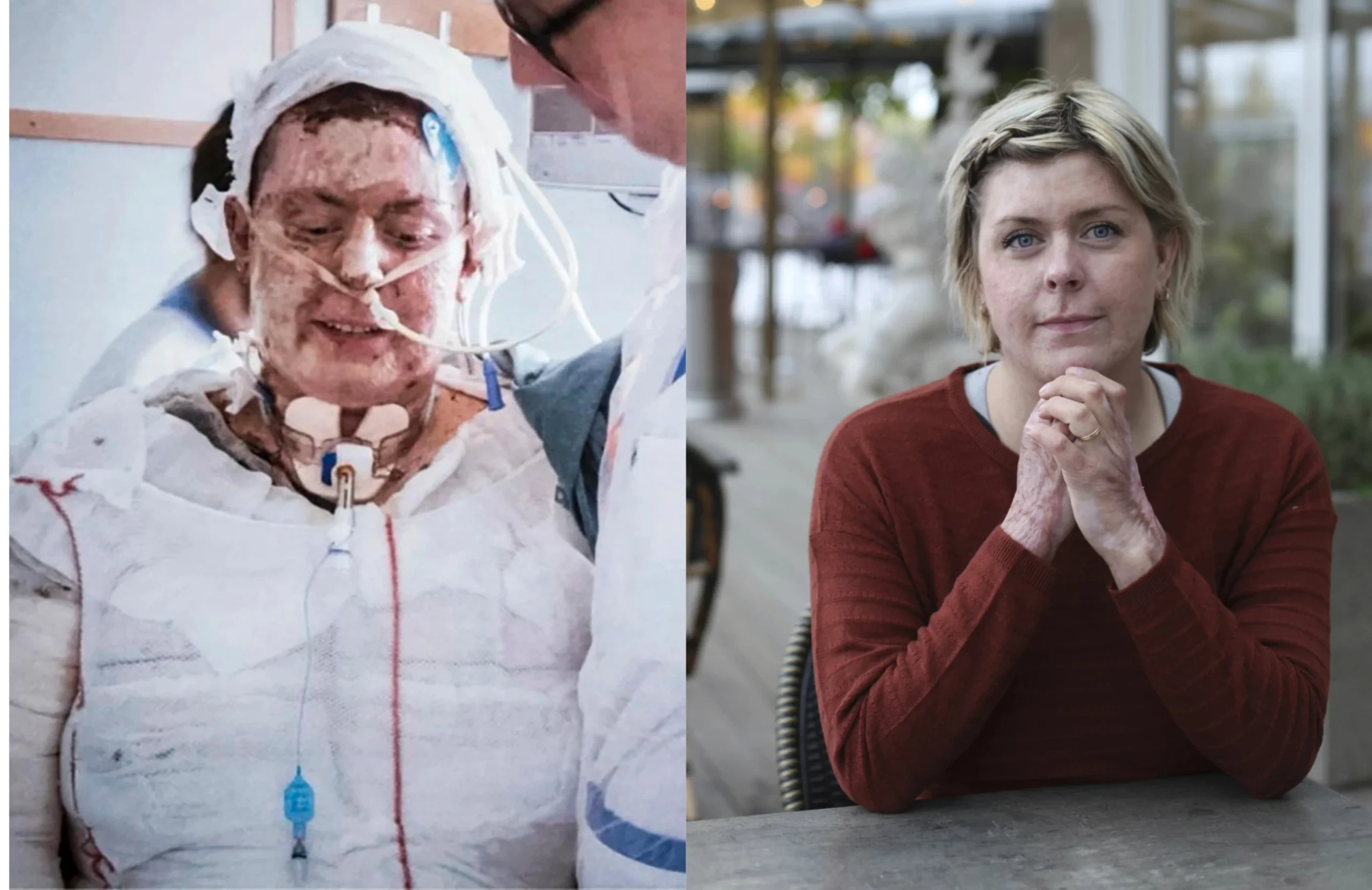 She Rushed Into Flames to Save Her Six Children — And Survived 93% ...
